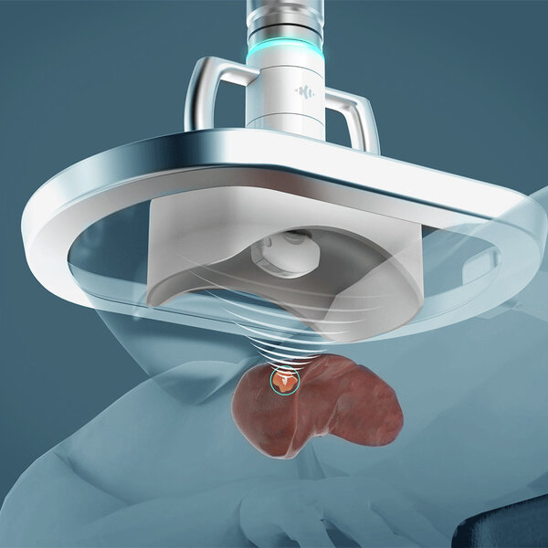 #PODCAST Focused Ultrasound Revolutionises Oncology: Histotripsy ...