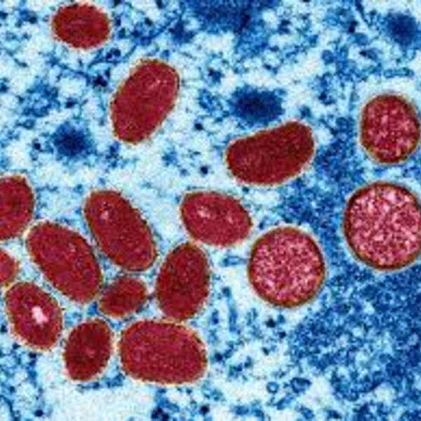 Close contacts of WA's first Monkeypox case in isolation - tap to hear ...
